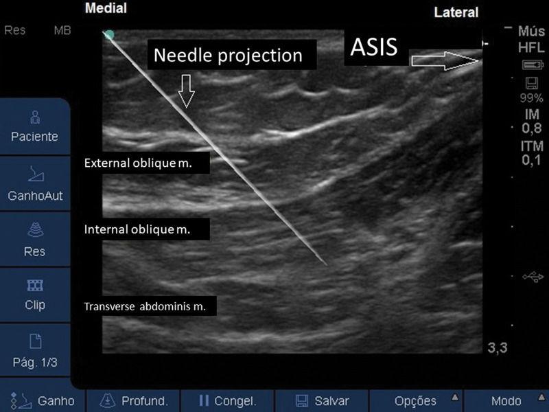 Ultrasound-guided peripheral abdominal wall blocks | Clinics