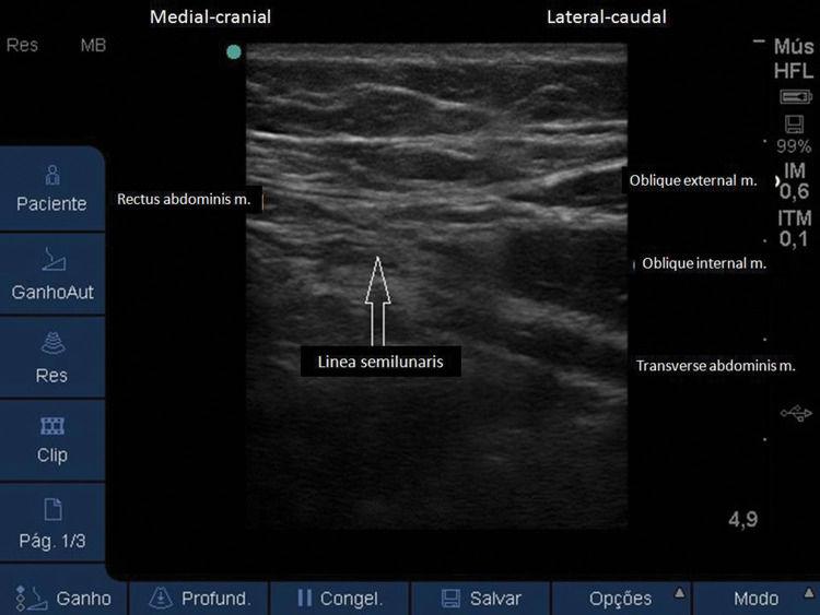 Ultrasound-guided peripheral abdominal wall blocks | Clinics