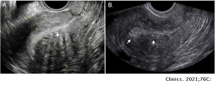 Association Of 2d And 3d Transvaginal Ultrasound Findings With
