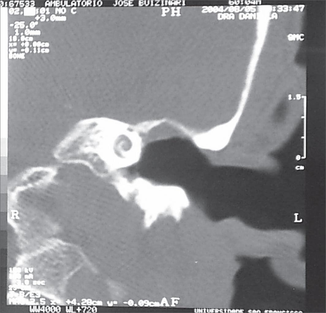 Automastoidectomy | Brazilian Journal of Otorhinolaryngology