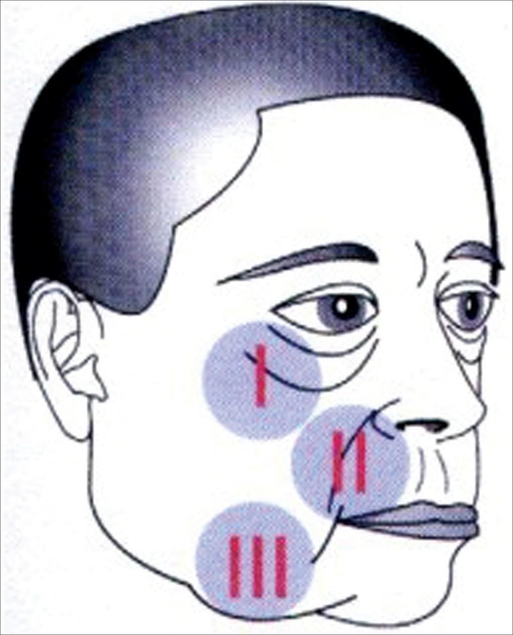 Subperiosteal facelift: a 5-year experience | Brazilian Journal of ...