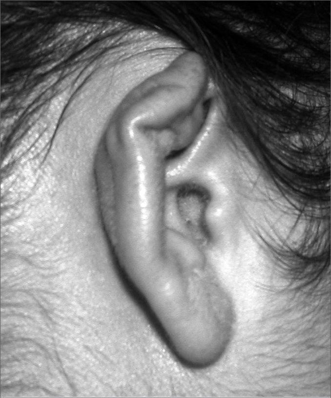 Auricular perichondritis by piercing complicated with pseudomonas ...