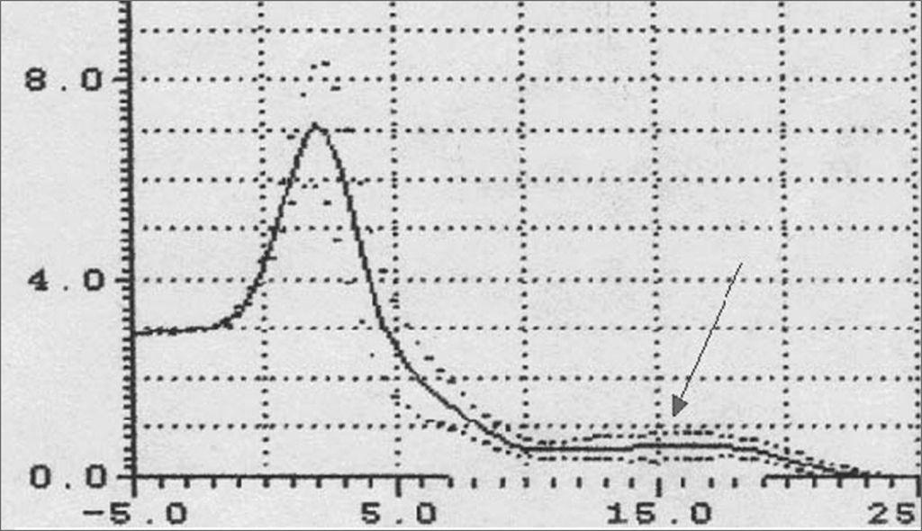 Acoustic pharyngometry: clinical and instrumental correlations in sleep ...