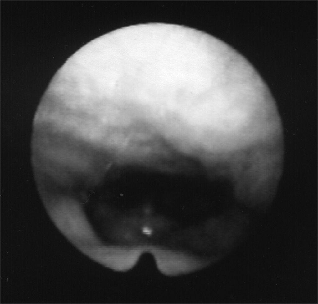 The difficult management of patients with respiratory segmental ...