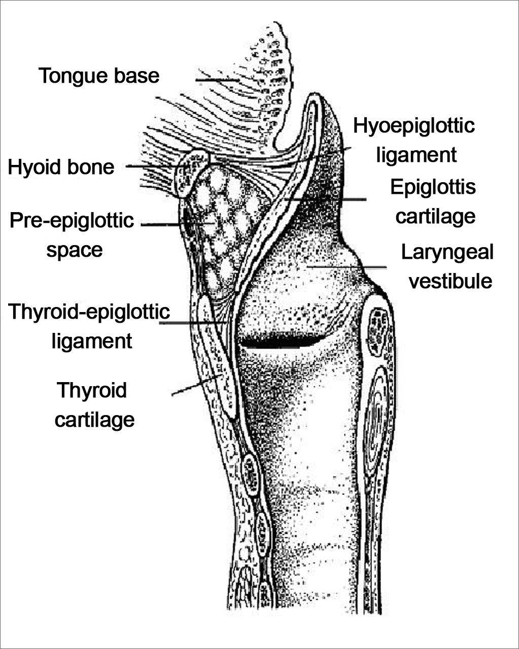 The importance of pre-epiglottis space invasion in the treatment ...