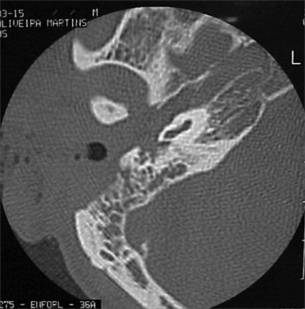 Foreign body in the Eustachian tube - case presentation and technique ...