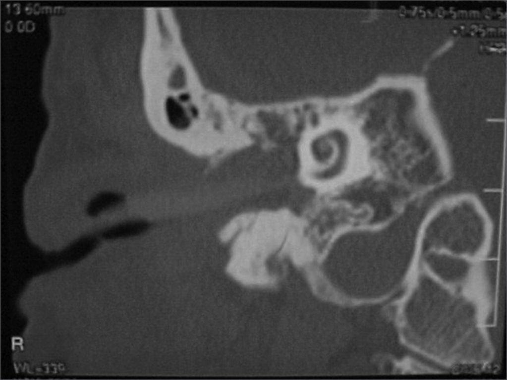 Foreign body in the Eustachian tube - case presentation and technique ...