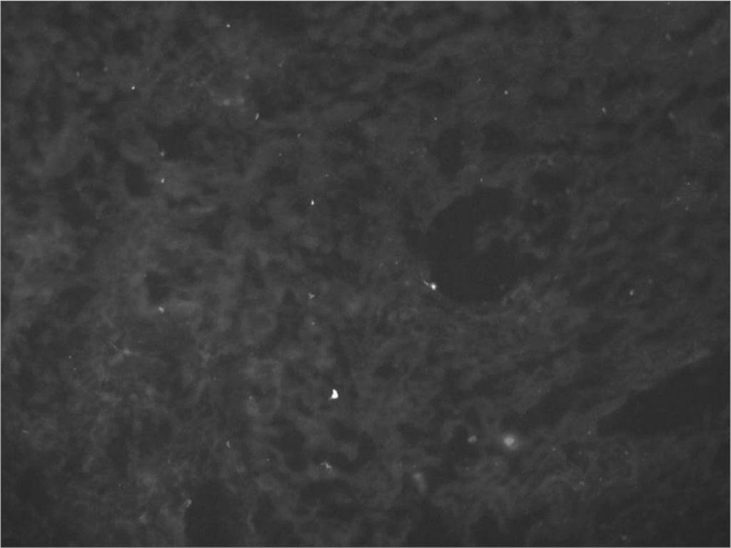 The role of immunoflorescence in the physiopathology and differential ...