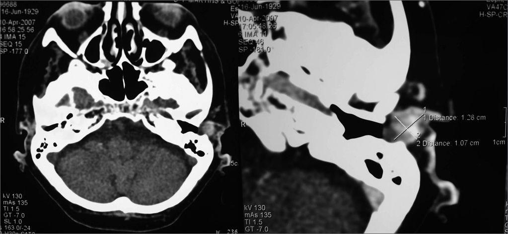 Adenoid Cystic Carcinoma of the External Auditory Canal | Brazilian ...