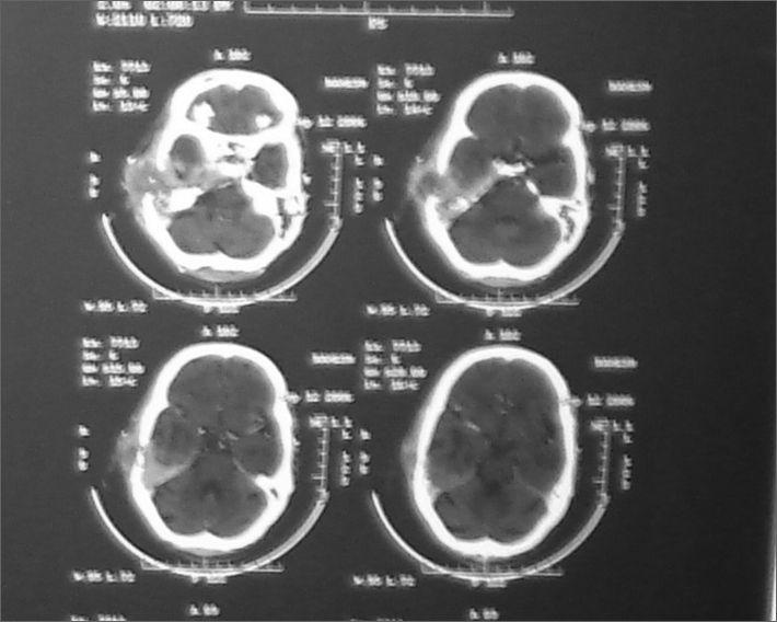 Temporal bone carcinoma with intracranial extension | Brazilian Journal ...