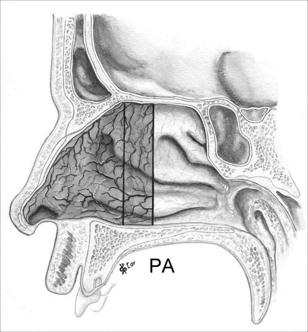 Reproducibility of the three-dimensional endoscopic staging system for ...