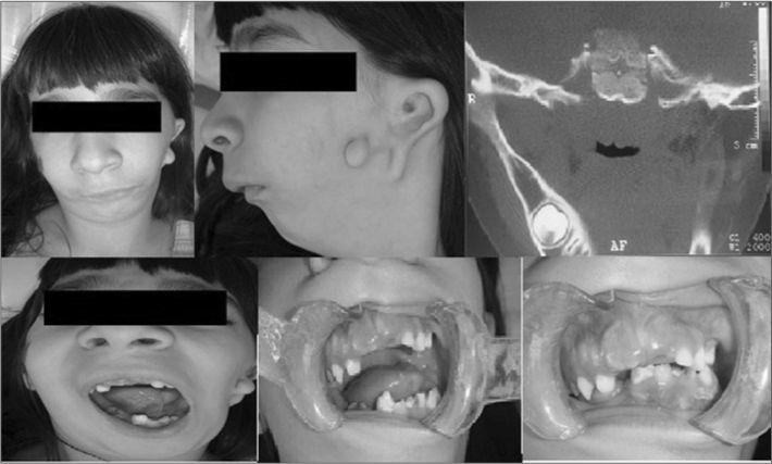Otomandibular microsomia: case report | Brazilian Journal of ...