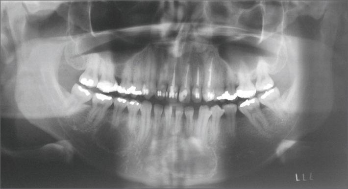 Mandibular simple bone cysts: a rare case of bilateral occurrence ...