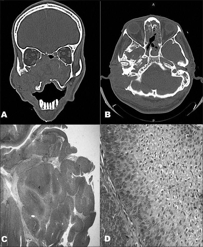 Sinonasal inverted papilloma involving the middle ear and the mastoid ...