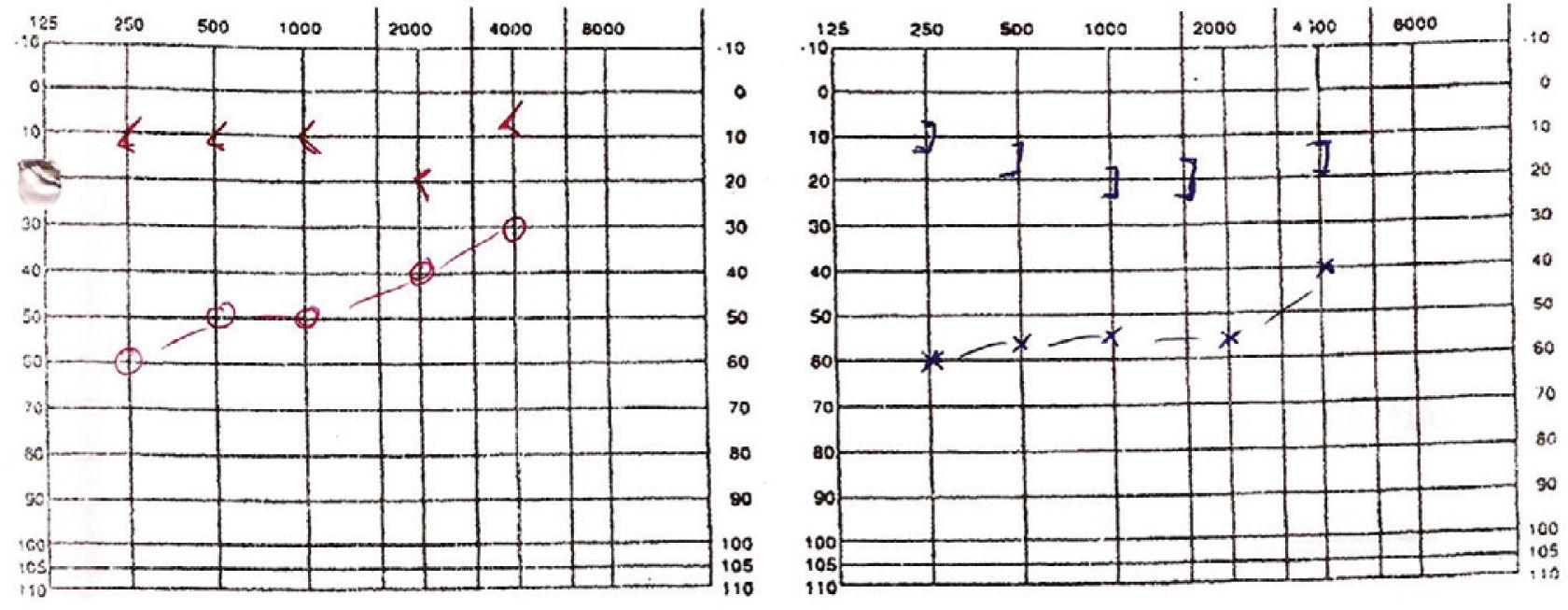 Congenital defects of the middle ear - uncommon cause of pediatric ...