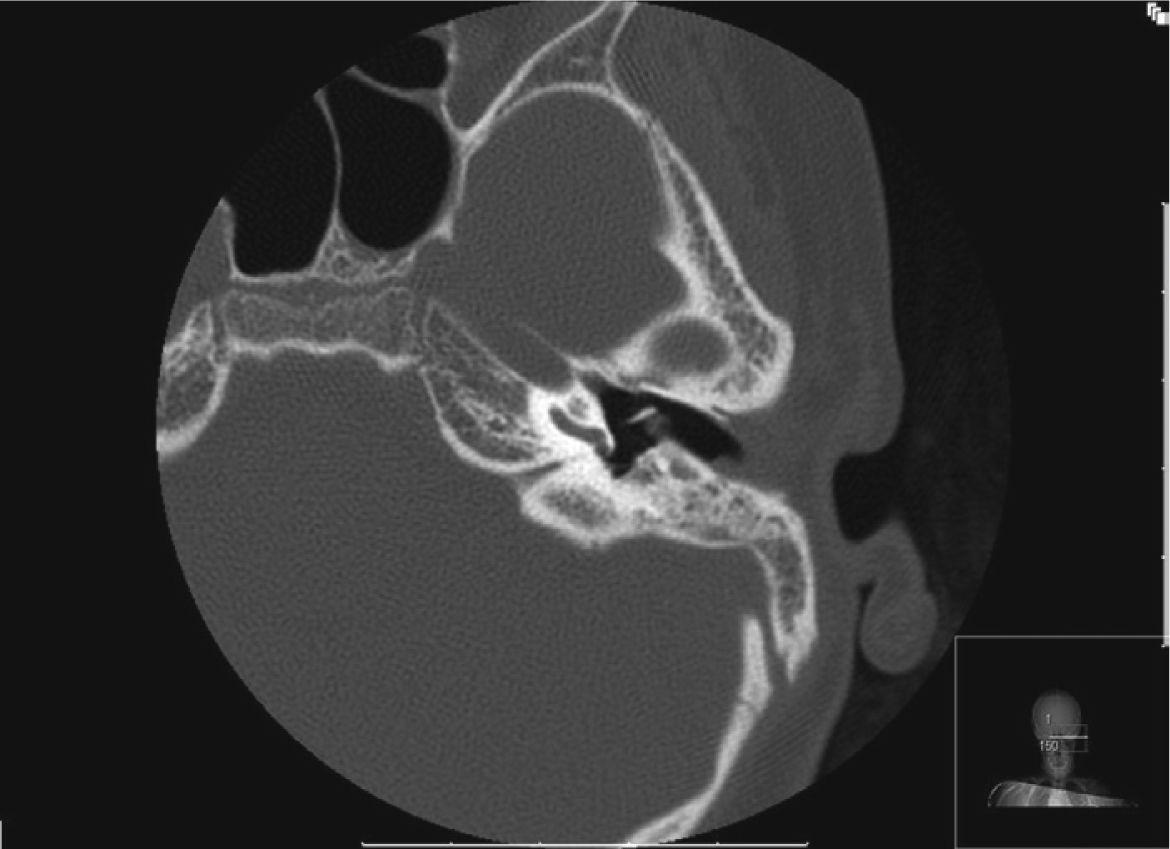 Congenital defects of the middle ear - uncommon cause of pediatric ...