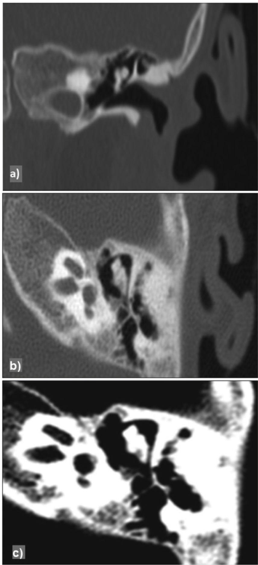 Congenital defects of the middle ear - uncommon cause of pediatric ...