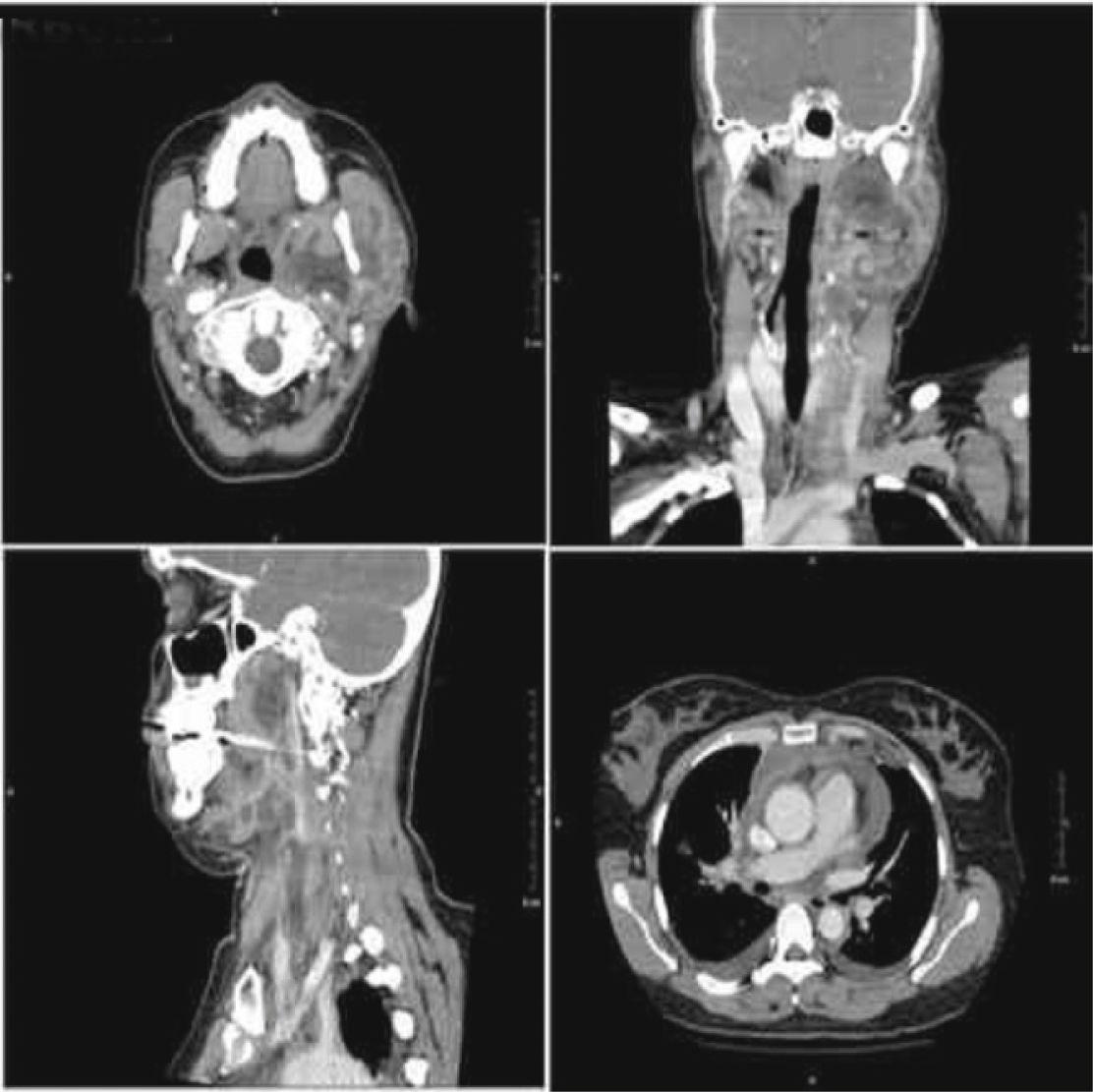Mediastinitis: parotid abscess complication | Brazilian Journal of ...