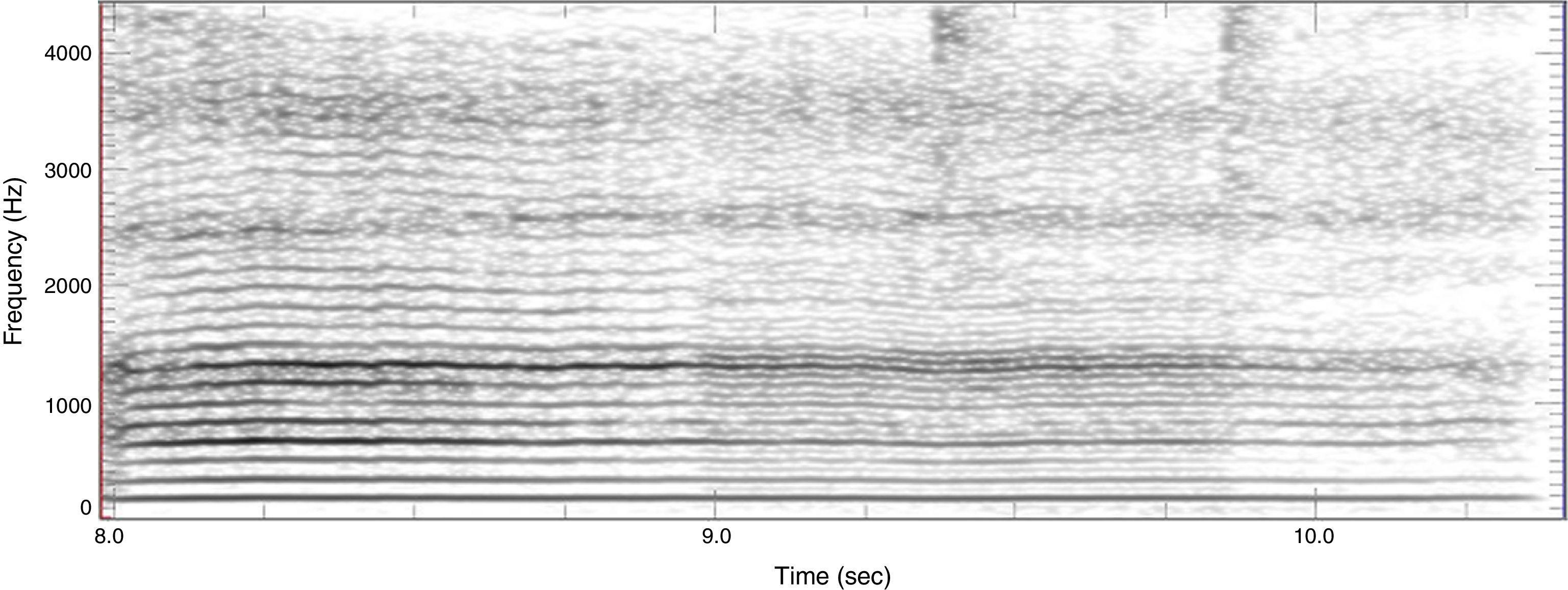 Subtotal arytenoidectomy for the treatment of laryngeal stridor in ...