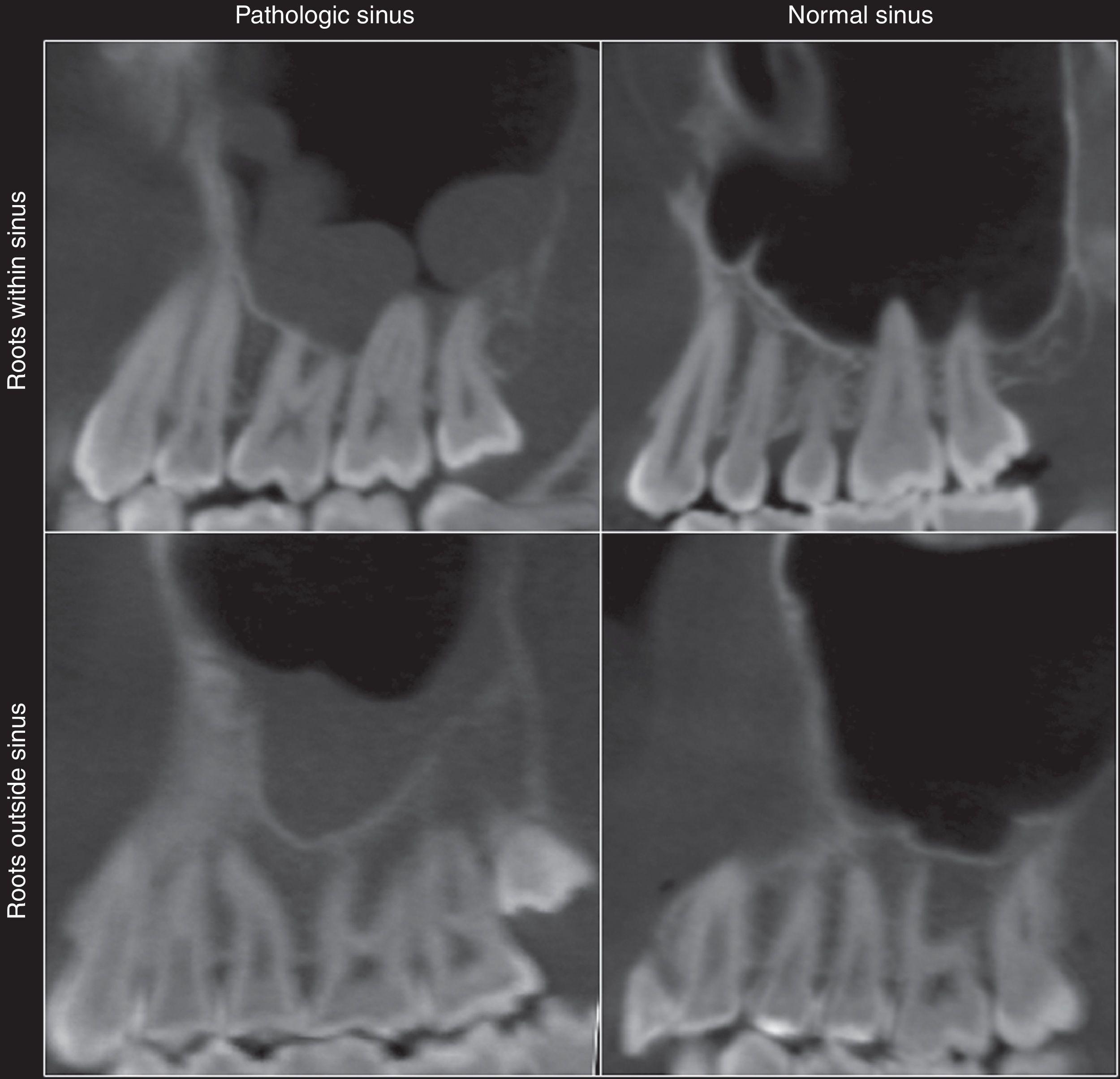 Association between maxillary sinus pathologies and healthy teeth ...