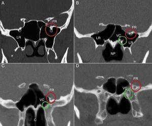 The sphenoid sinus, foramen rotundum and vidian canal: a radiological ...