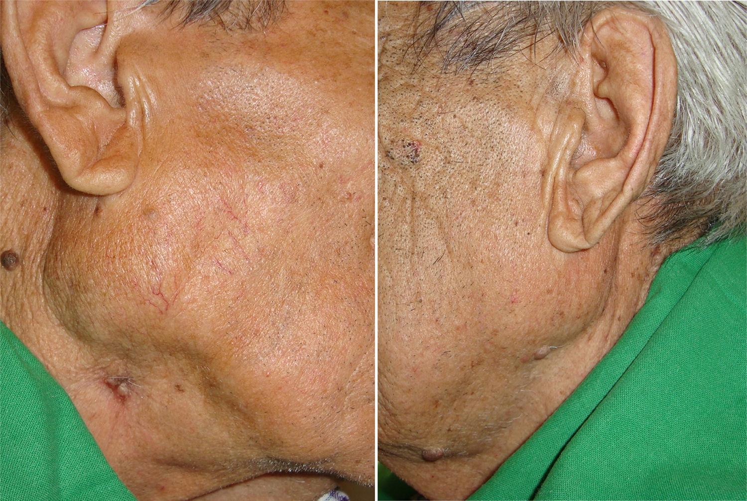 Bilateral parotid glands infection caused by Calmette-Guerin Bacillus ...