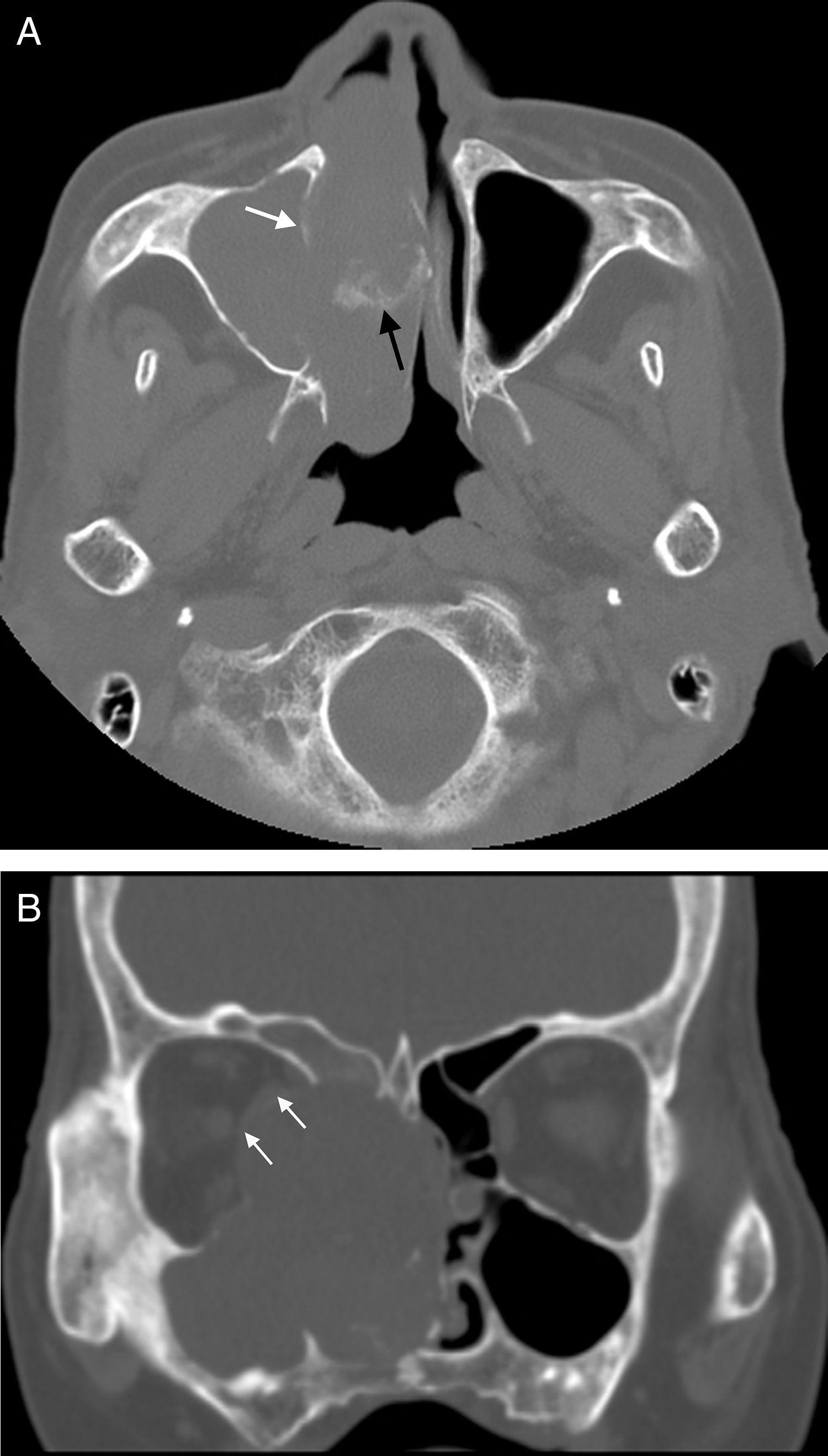 Undifferentiated high-grade pleomorphic sarcoma of ethmoid sinus: a ...