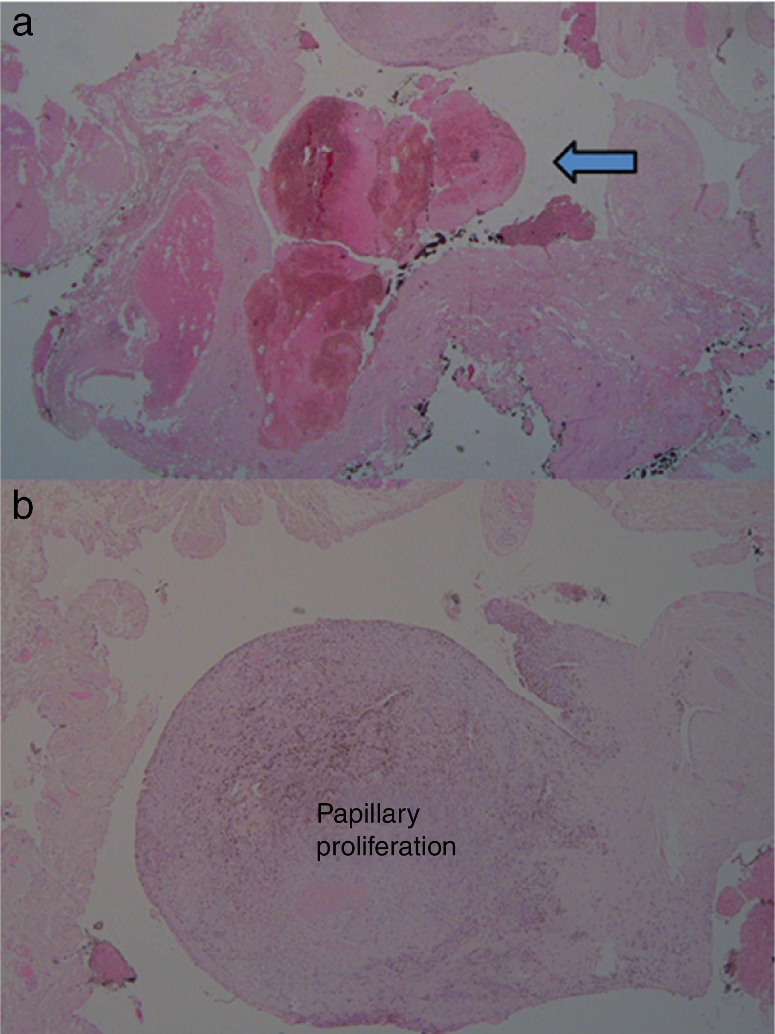 Parotid Masson's tumor: case report | Brazilian Journal of ...