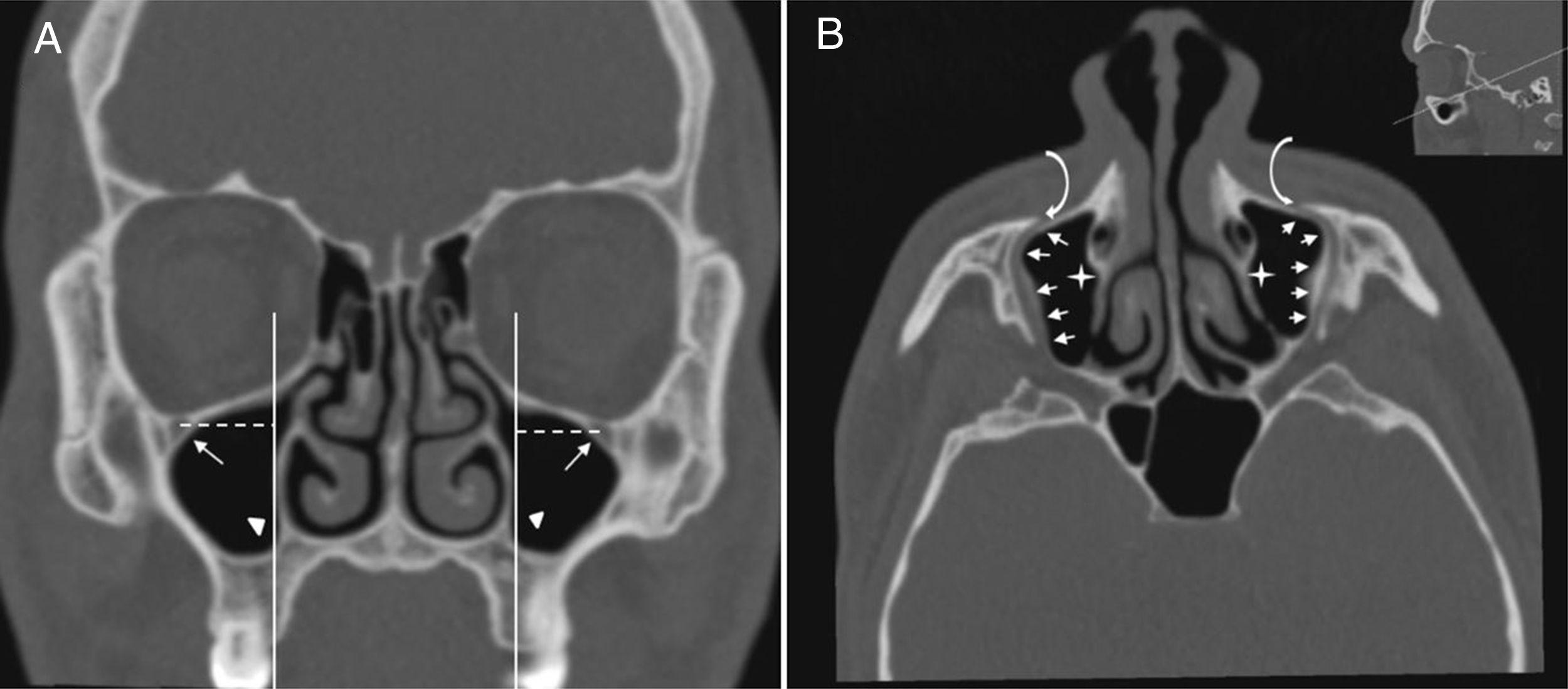 Computed tomography evaluation of the morphometry and variations of the ...