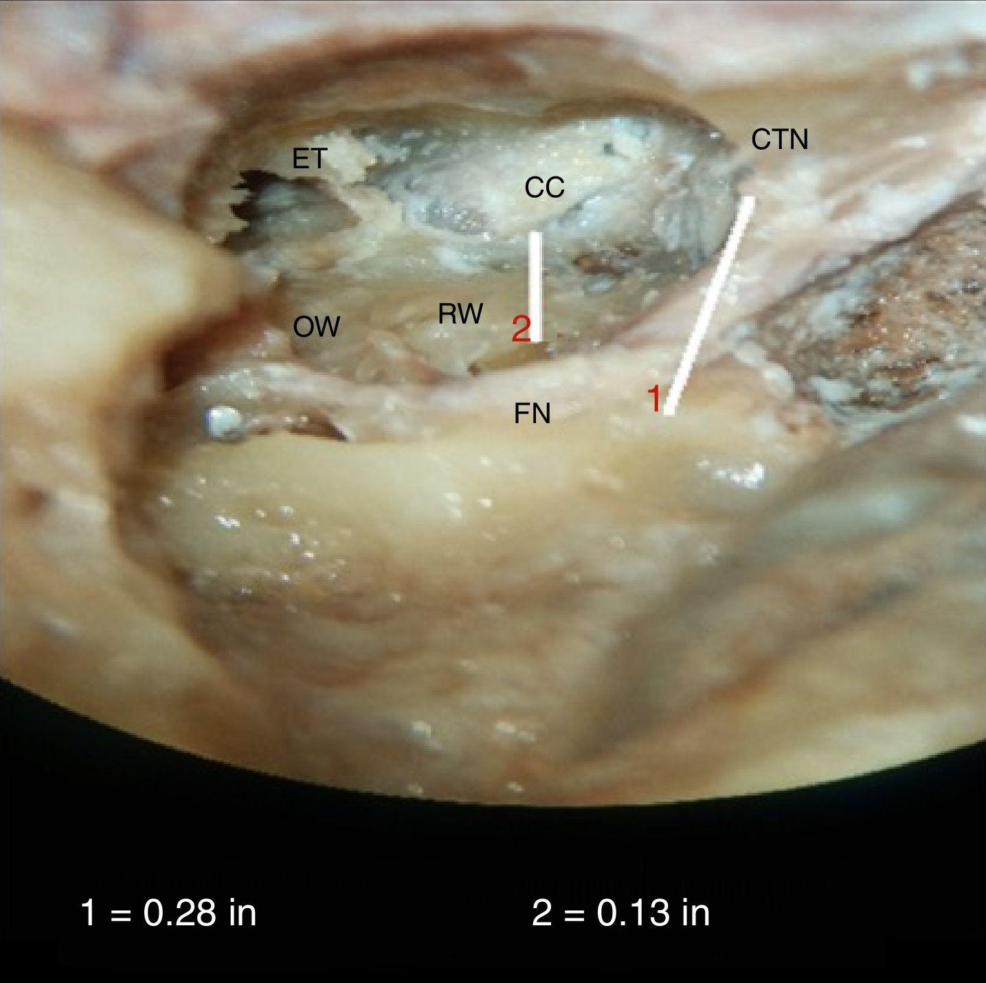 Applied anatomy of round window and adjacent structures of tympanum ...