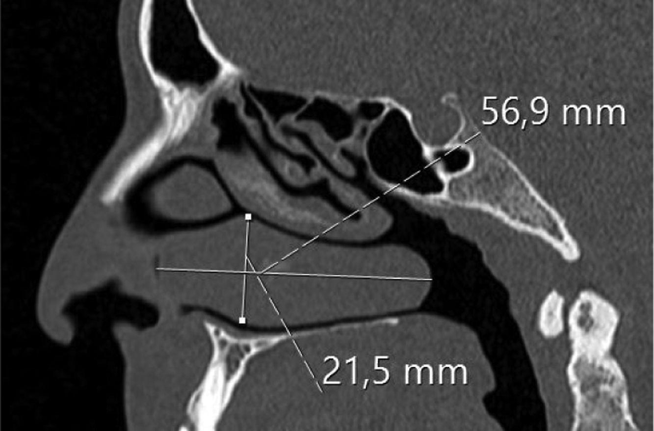 Changes in substance P levels of inferior turbinate in patients with ...