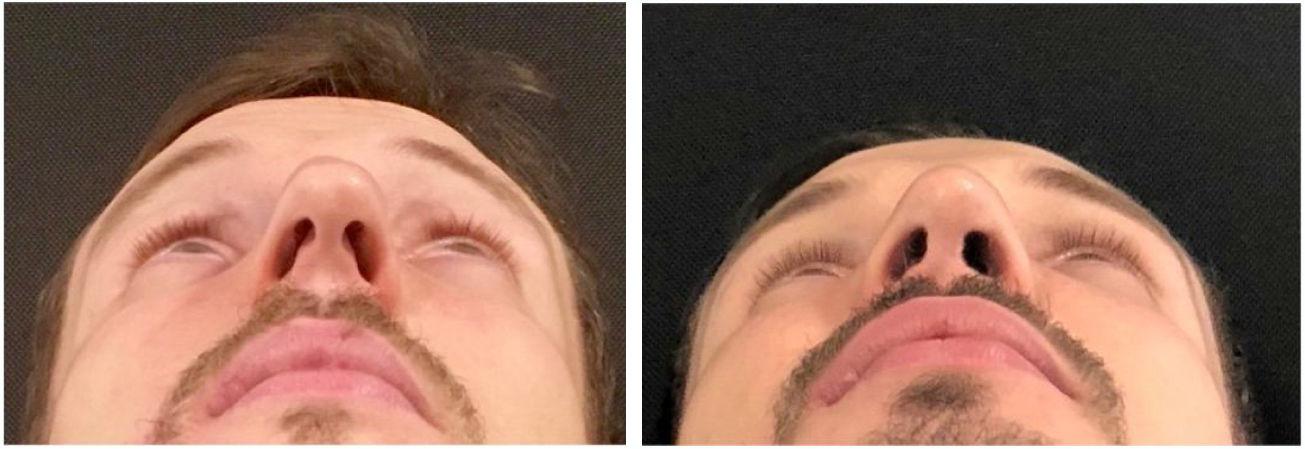 Algorithm for the treatment of external nasal valve insufficiency ...