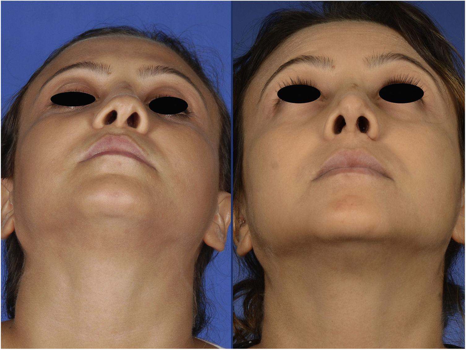 Deviated Septum From Coke