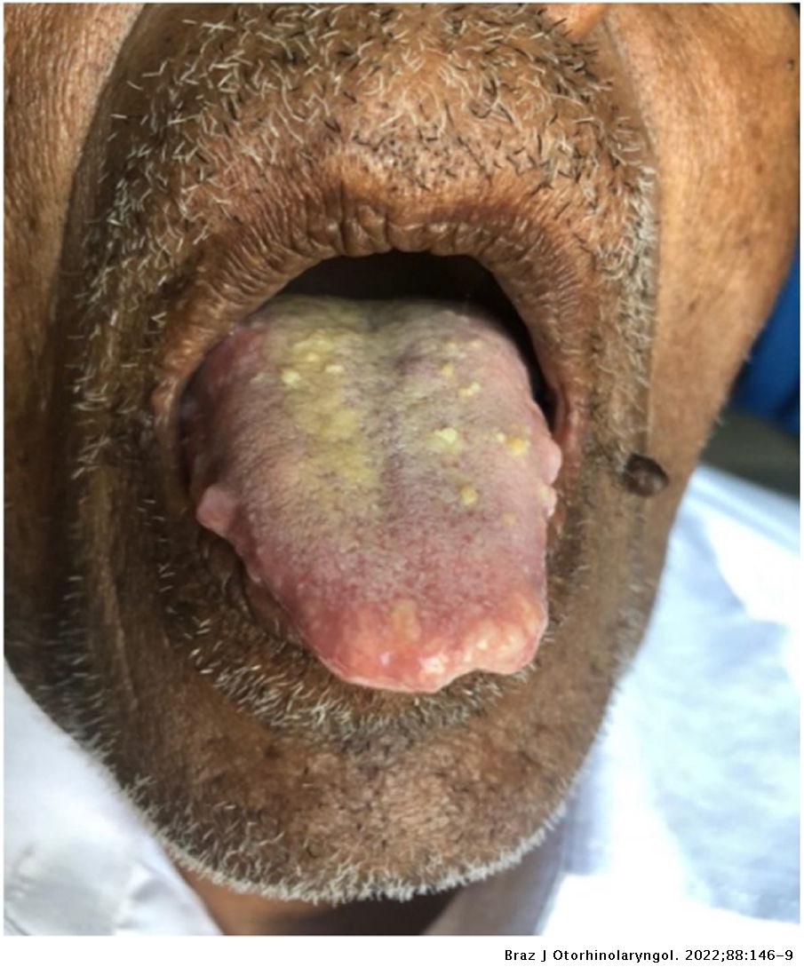 Oral Manifestations Of Systemic Amyloidosis An Aid To Diagnosis Of Multiple Myeloma Report Of