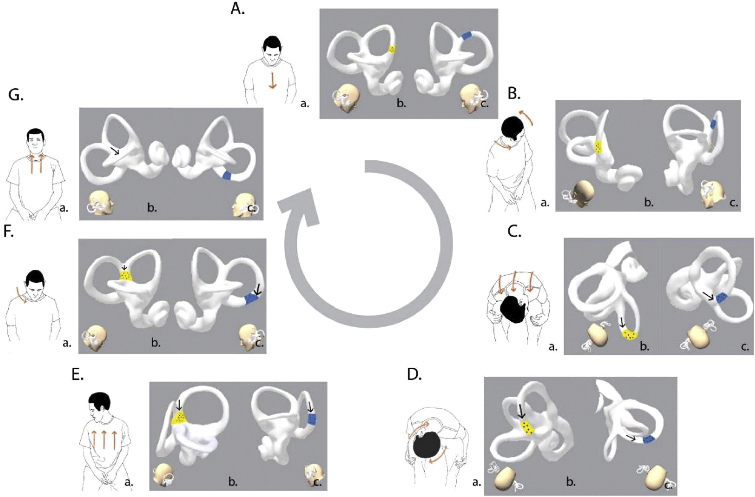 Horizontal Canal Repositioning Maneuver