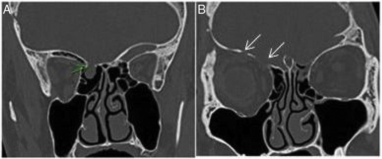 Management of coexistent sinonasal pathology in patients undergoing ...