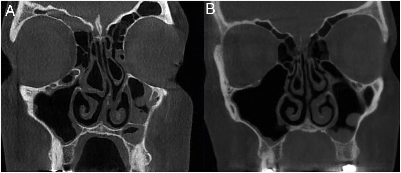 Assessing the efficacy of a modified crushing technique for the ...