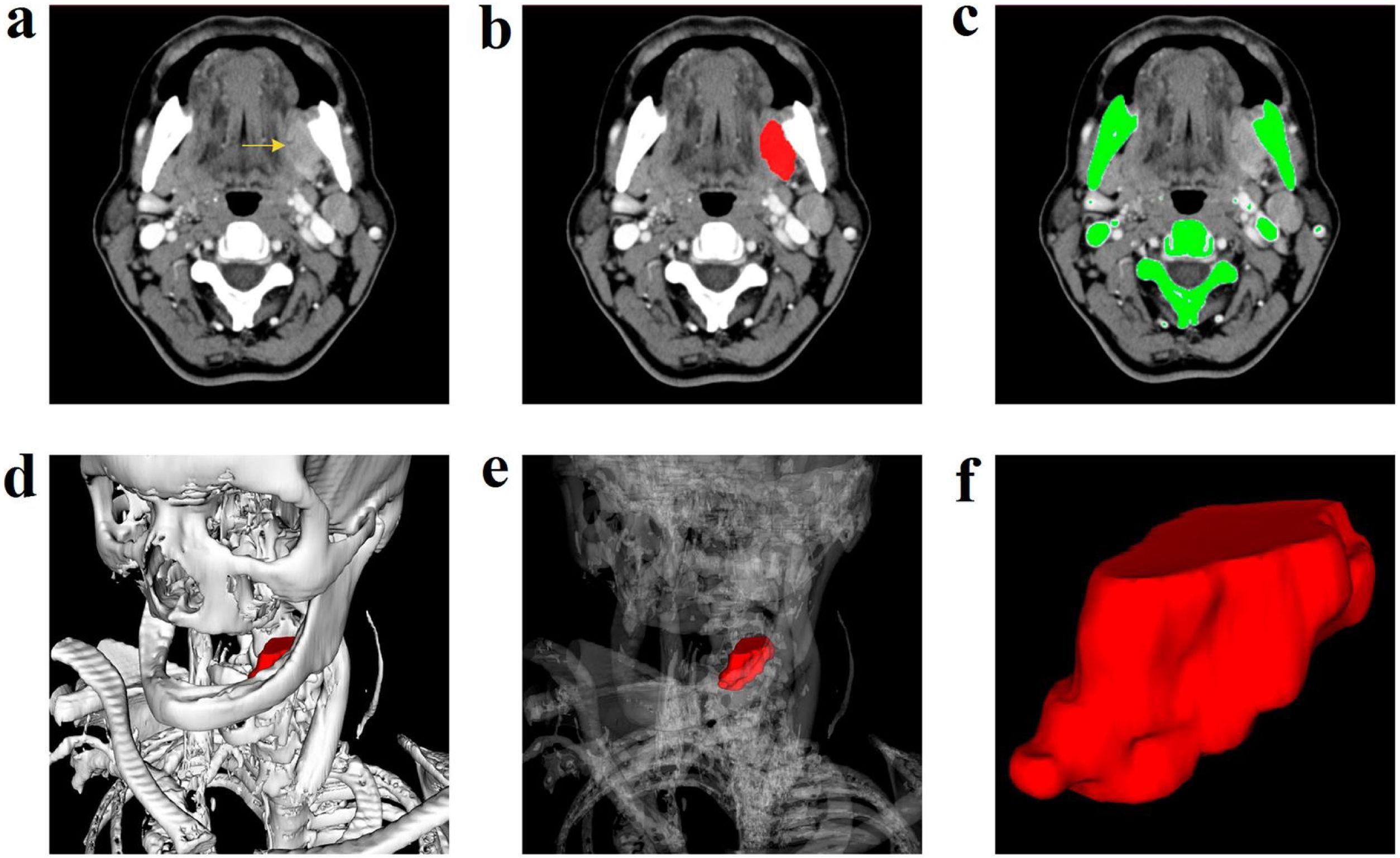 Free three-dimensional image software in local extension assessment of ...