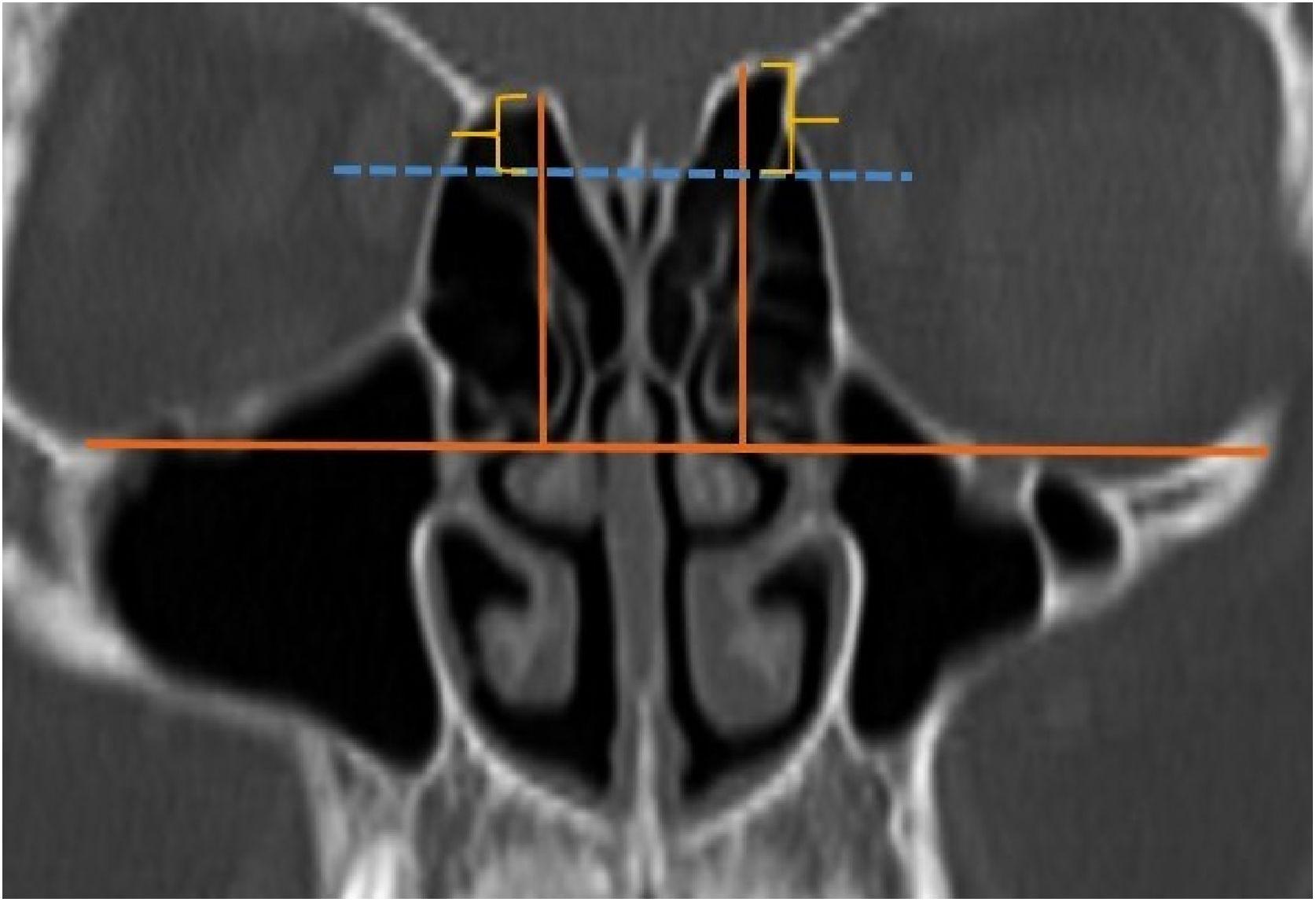 Age-dependent differences of the depth of olfactory fossa in children ...
