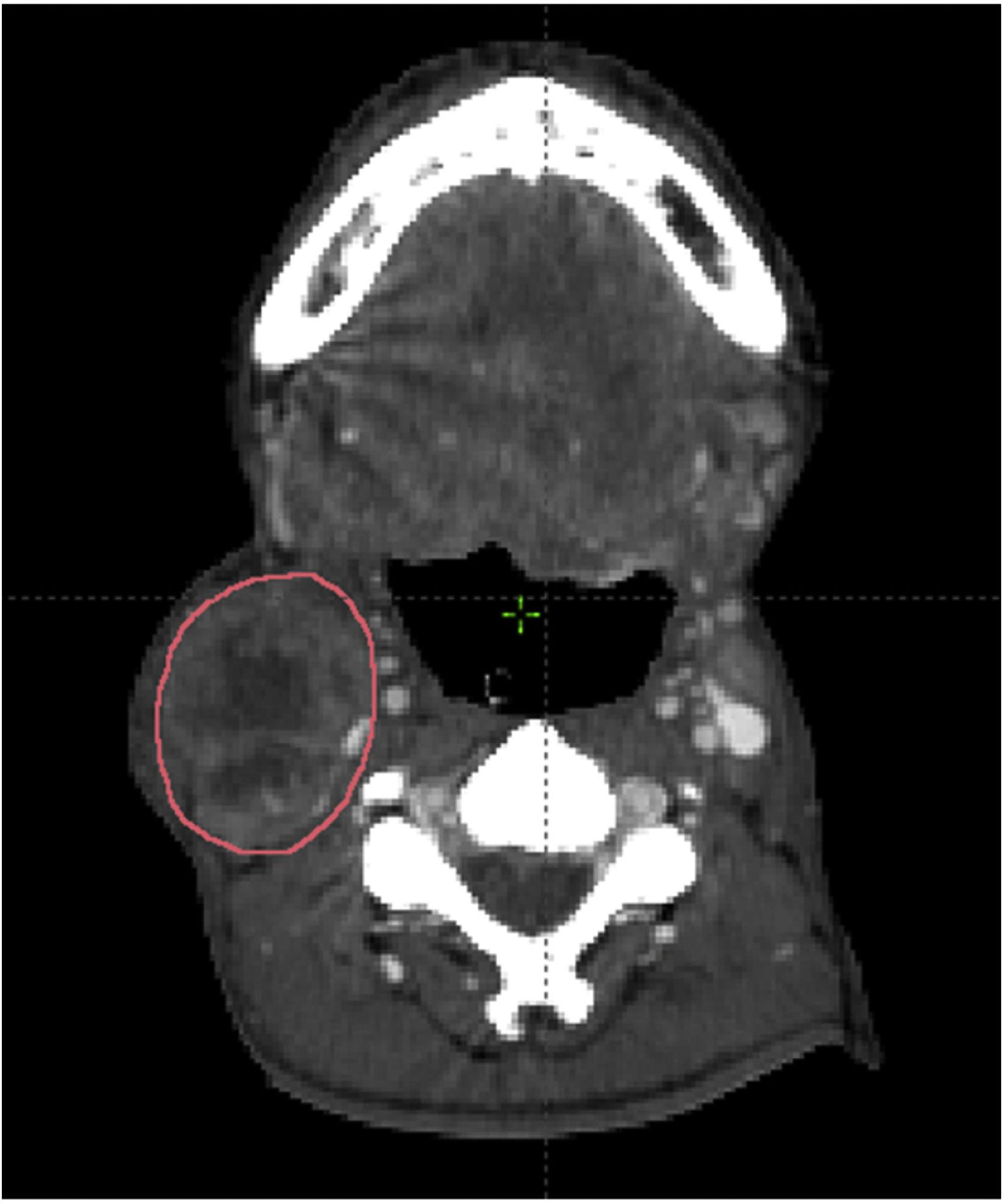 Imaging nodal volume and survival in oral tongue cancer with cervical ...