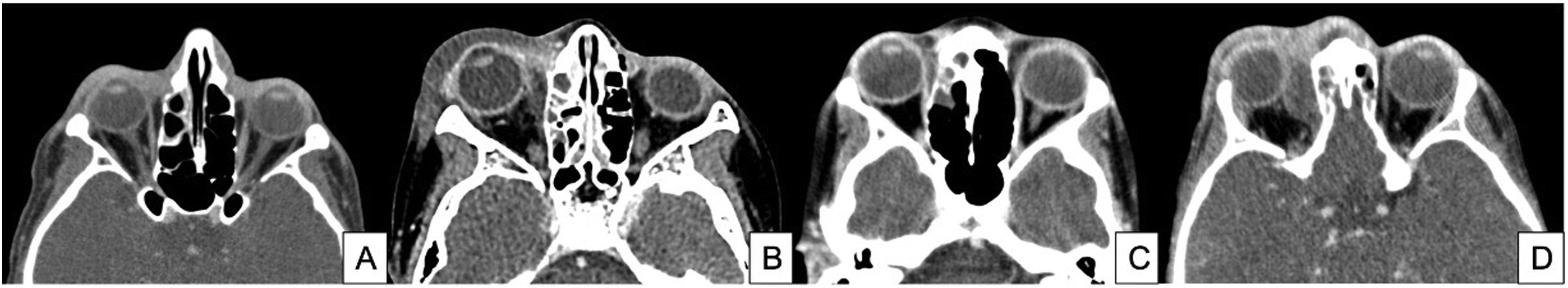 Revisiting the orbital complications of acute rhinosinusitis ...