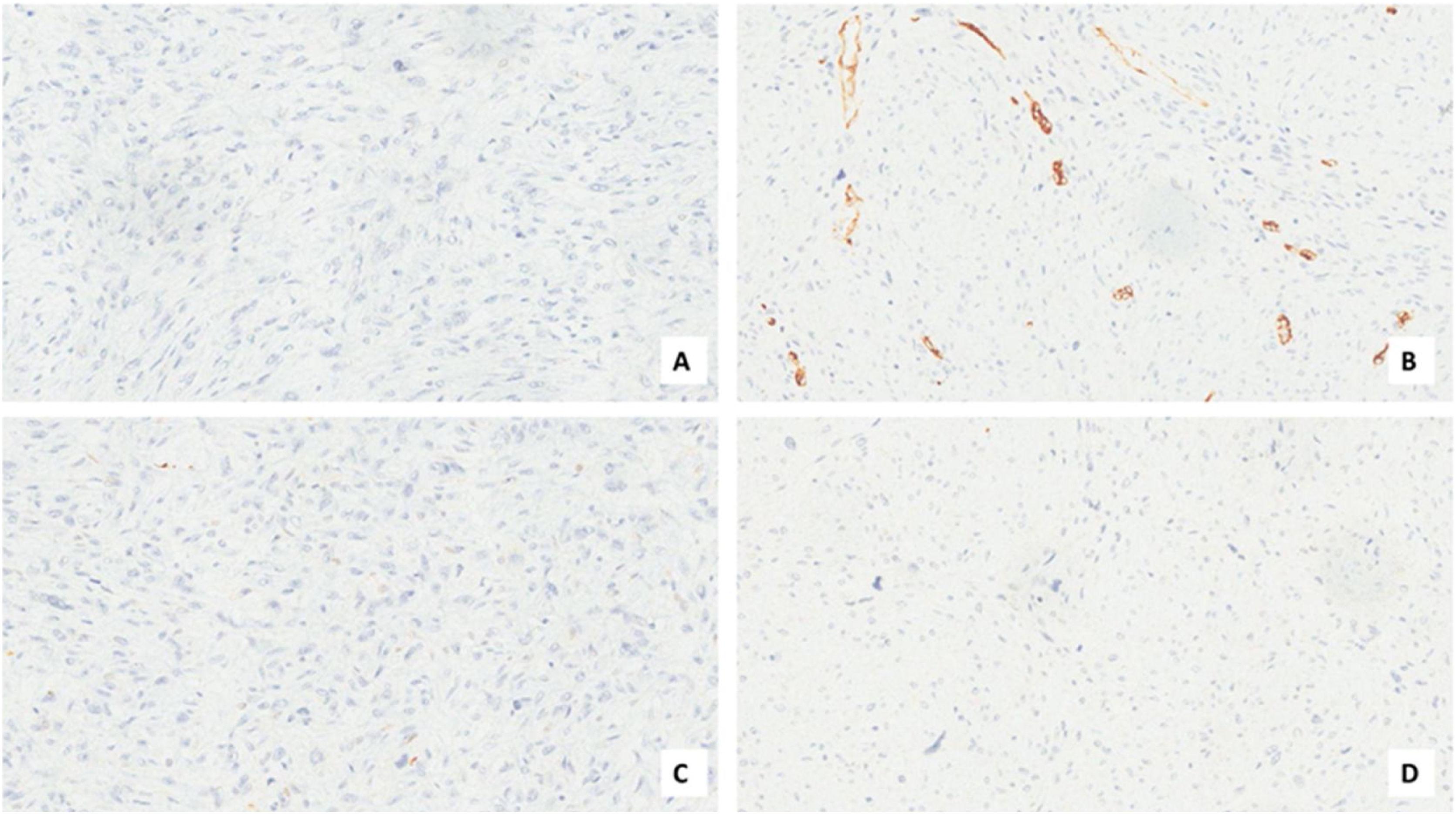 Long-term follow-up after surgical management of laryngeal malignant ...