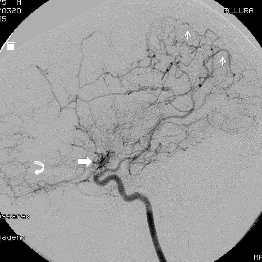 El signo de la hiedra: un patrón de realce leptomeníngeo difuso ...