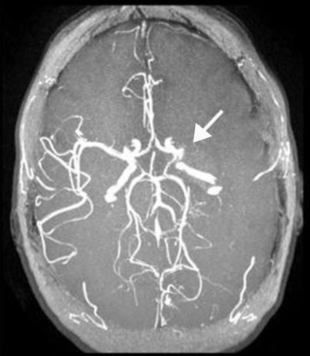 Accidente cerebrovascular isquémico en paciente joven asociado a ...