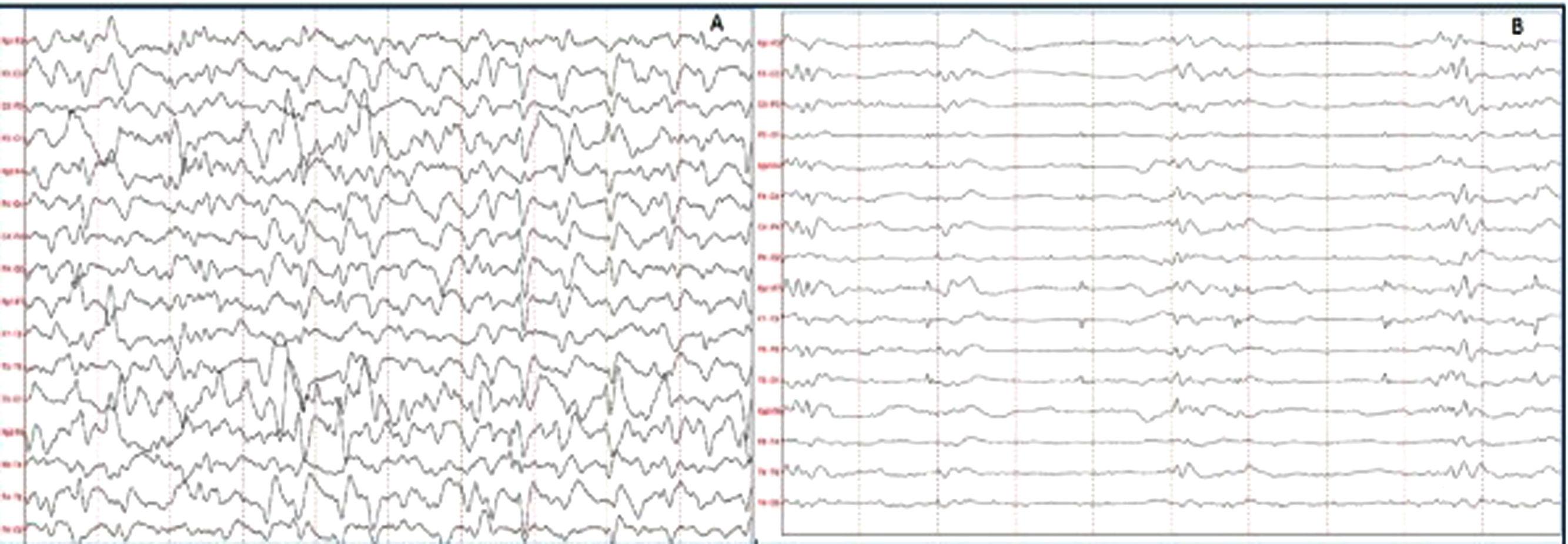 El estatus epiléptico refractario de reciente inicio: presentación de ...