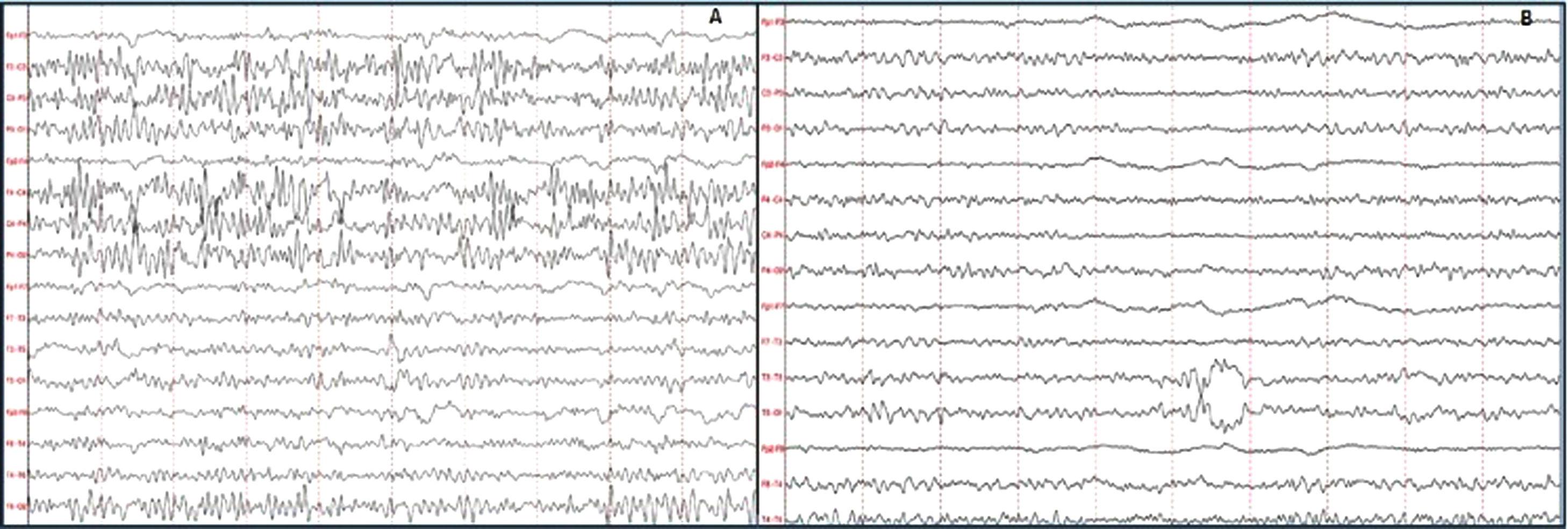 El estatus epiléptico refractario de reciente inicio: presentación de ...
