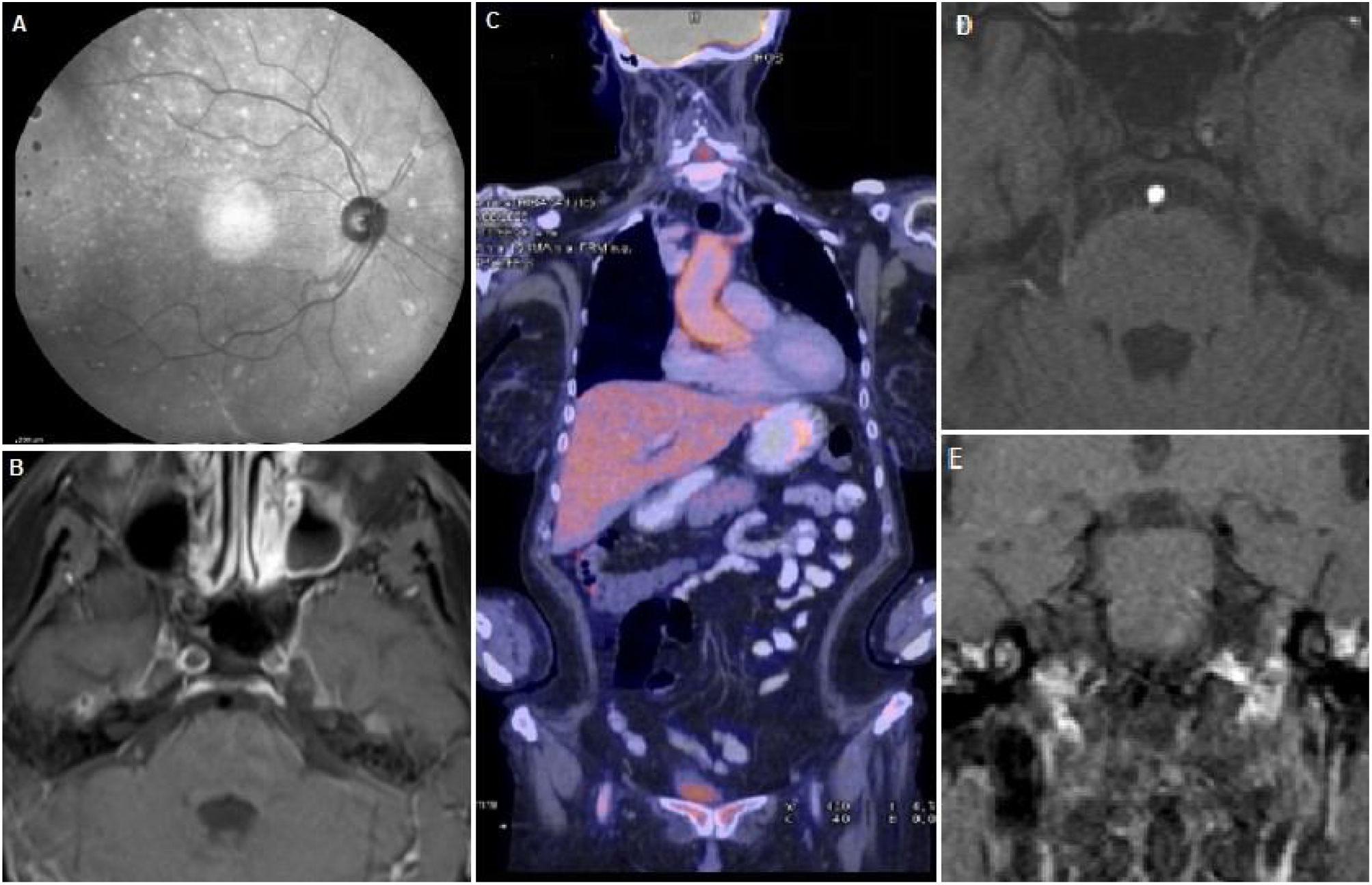 Síndrome de Cogan asociado a vasculitis sistémica con evolución tórpida ...