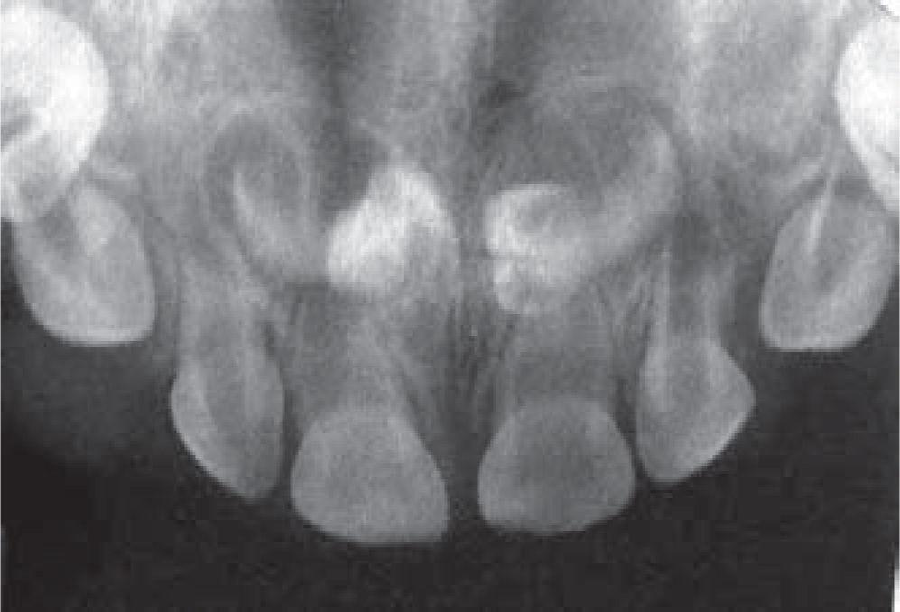 Dientes supernumerarios en dentición primaria asociados a pólipos ...