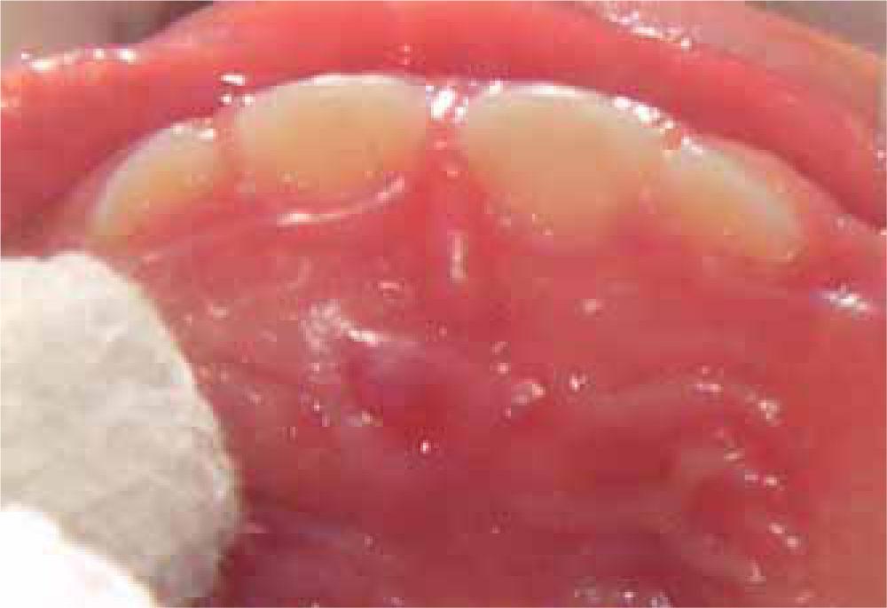 Dientes supernumerarios en dentición primaria asociados a pólipos ...