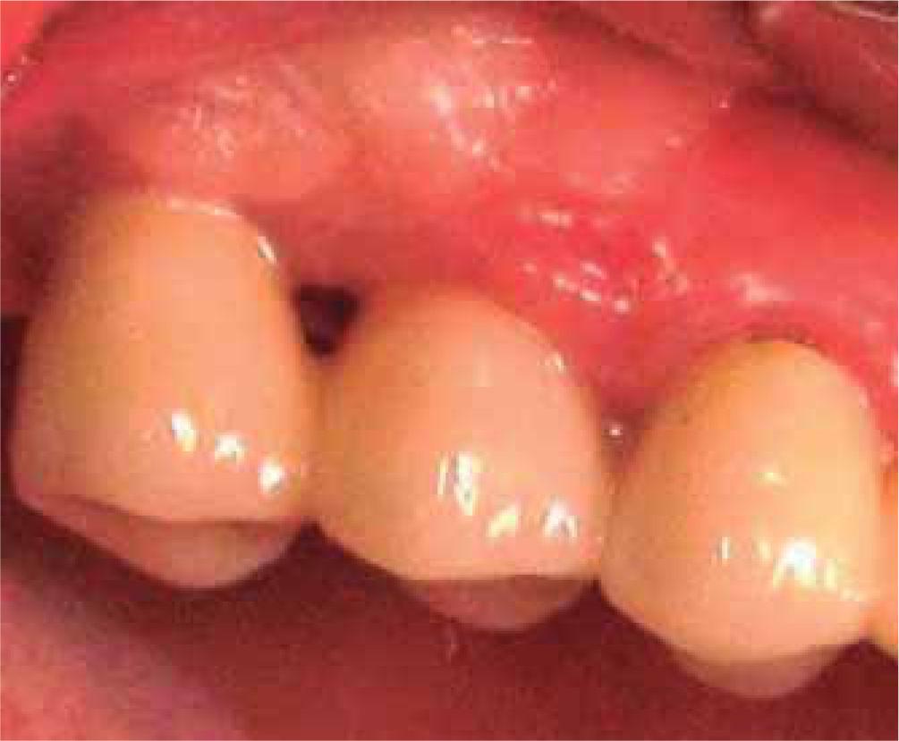 Elevación de seno maxilar y colocación simultánea de implantes ...